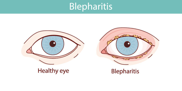 Blepharitis Eyelid Cleaning Treatment in Derry, NH